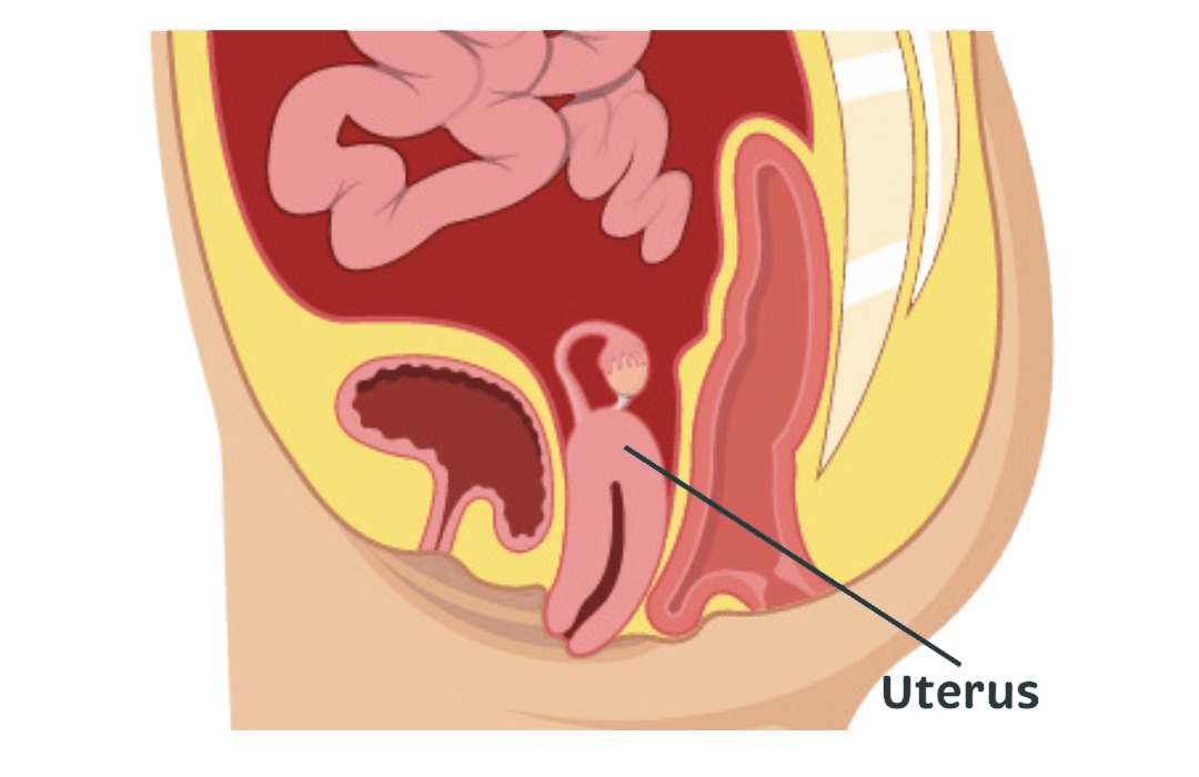 Advanced Stage Pelvic Organ Prolapse - Catherine Hamlin Fistula ...